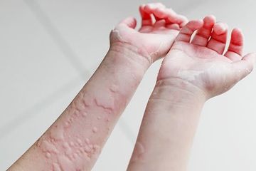 Berita Penyebab Biduran Yang Jarang Diketahui Terbaru Hari Ini - Grid ...