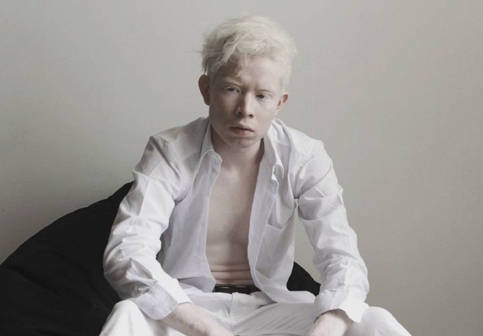 Pesona Penderita Albino Dari Berbagai Ras Ini Super Mengagumkan - Semua ...