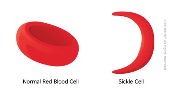 Mengenal Penyakit Anemia Sel Sabit, Kelainan Pada Sel Darah Merah ...