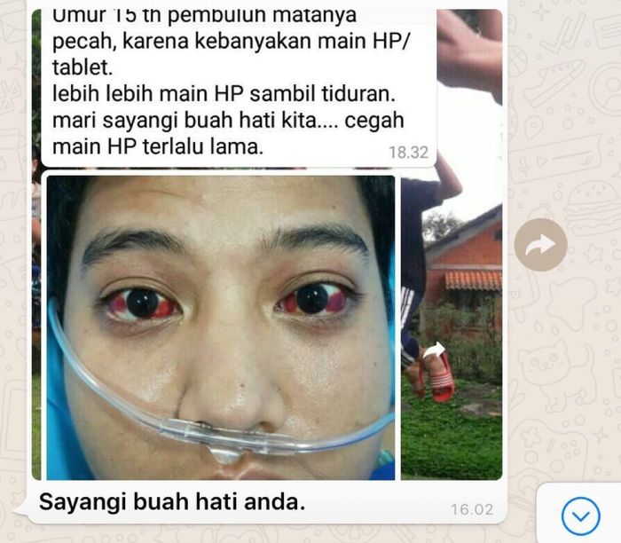 Viral Foto Pembuluh Mata Pecah Akibat Main Gadget, Ini Penyebab ... Viral Foto Pembuluh Mata Pecah Akibat Main Gadget, Ini Penyebab ...