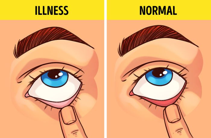 Cara Mudah Tahu Apakah Kita Menderita Anemia atau Enggak! Wajib Tahu ...