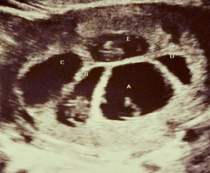 Divonis Mandul Oleh Dokter, 2 Tahun Kemudian Wanita Ini Lahirkan Bayi ...