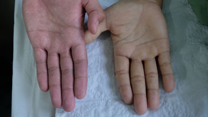 Jangan Abaikan, Ini 6 Tanda Anemia dan Perawatan Alaminya! - Semua ...