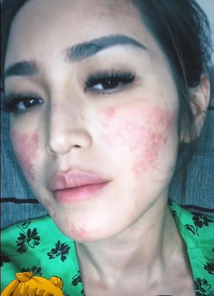 Sempat Alami Bercak Merah pada Wajah hingga Tak Bisa Syuting Selama 7 ...