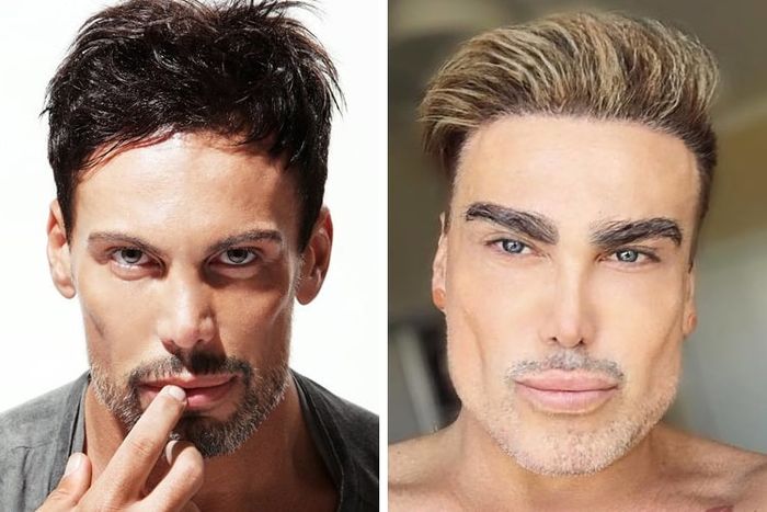 Kelar Operasi Hidung, Alat Vital Cowok Selebgram Ini Tegak Selama 3 ...