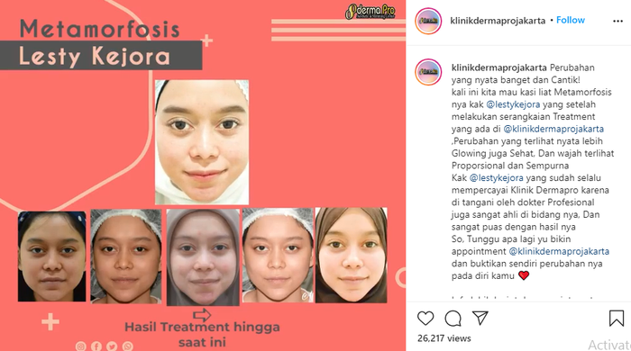 PERUBAHAN Wajah Lesty Kejora Sebelum dan Sesudah Dipermak, Bagian Ini ... PERUBAHAN Wajah Lesty Kejora Sebelum dan Sesudah Dipermak, Bagian Ini ...