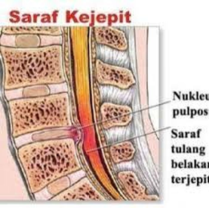 Penanganan Saraf Kejepit yang Baik dan Benar Serta Pencegahannya ...