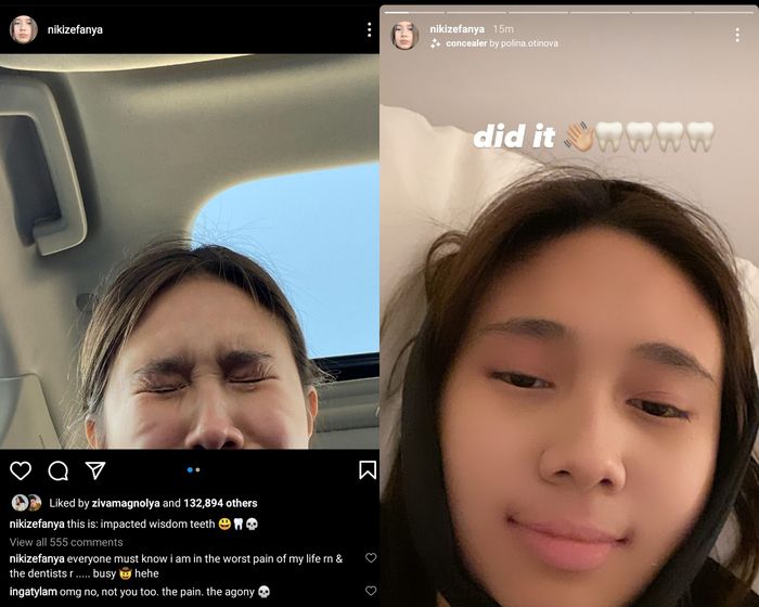 Gigi Bungsunya Tumbuh, Niki Zefanya Alami Kesakitan hingga Harus Cabut ...