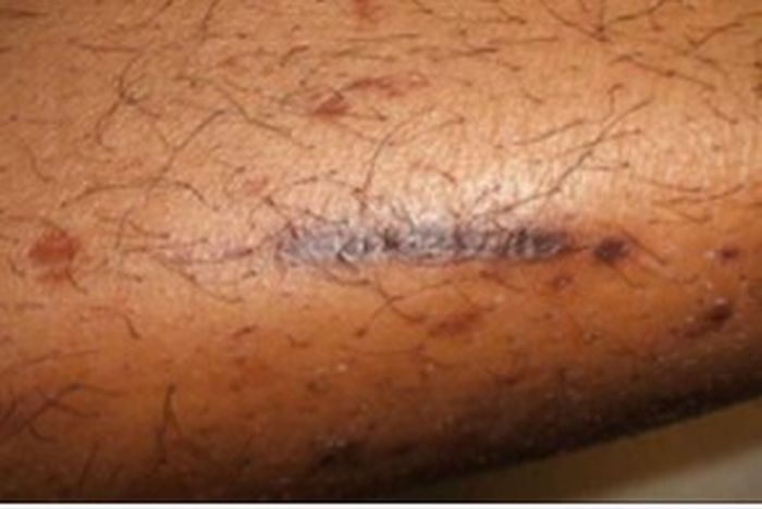 Ciri Seseorang Menderita Diabetes, Lihat 12 Tanda Ini di Kulitnya ...