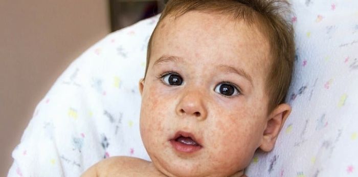 Penyakit Infeksi Pada Bayi Baru Lahir, ASI Bisa Membantu Mengatasi ...