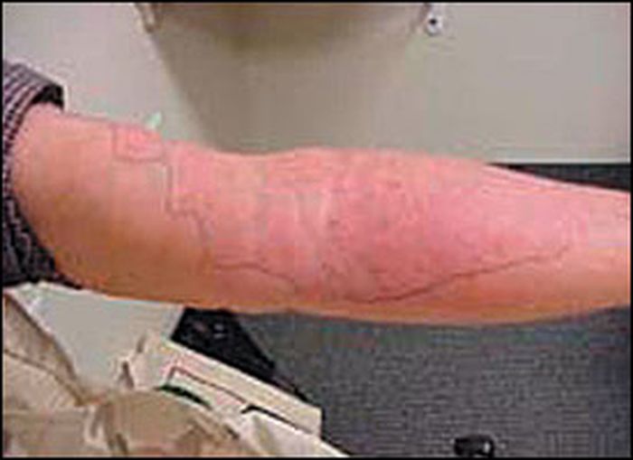 Penyakit Infeksi Kulit Selulitis, Waspada Bagi Penderita Diabetes ...