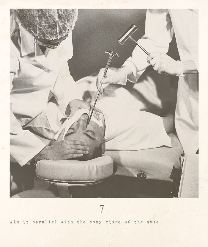 Sejarah Mengerikan Lobotomi: Ketika Ribuan Kepala Manusia Dilubangi ...