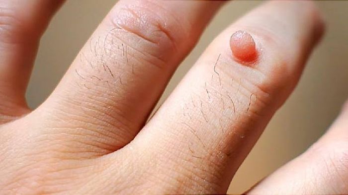 Kenali Skin Tag yang Mirip Seperti Kutil, Gimana Cara Menghilangkannya ...