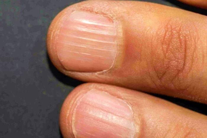 Penyebab Kuku Bergaris Vertikal, Bahaya atau Tidak? Ini Penjelasannya! - Stylo