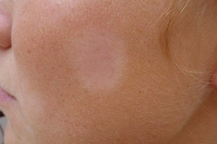 Bahayakah Ruam Putih di Wajah? Ini Penyebab dan Cara Mengatasinya ...