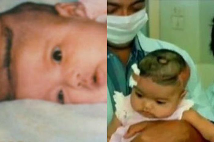 Lahir Kembar Siam dengan Dempet Kepala 29 Tahun Lalu, Begini Kabar ...