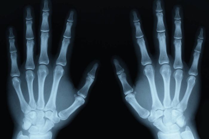 Untuk Menguji Sinar X Temuannya, Rontgen Menjadikan Istri sebagai ...