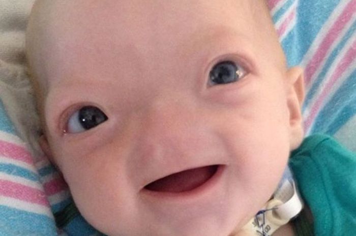 Kenali Penyakit Langka Arhinia, Hanya Terjadi pada 47 Bayi di Dunia ...