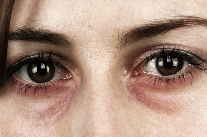 Ganggu Penampilan, Ternyata Ini Penyebab Kantong Mata Hitam Kerap Muncul