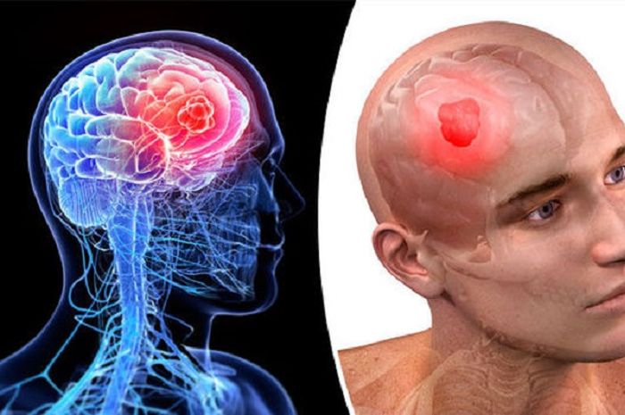 Anak Marcella Zalianty Mengidap Tumor Otak, Ternyata Kebiasaan Ini Bisa ... Anak Marcella Zalianty Mengidap Tumor Otak, Ternyata Kebiasaan Ini Bisa ...