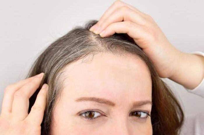 Muncul Uban di Usia Muda, Awas Tanda 5 Gangguan Kesehatan Ini! - CewekBanget