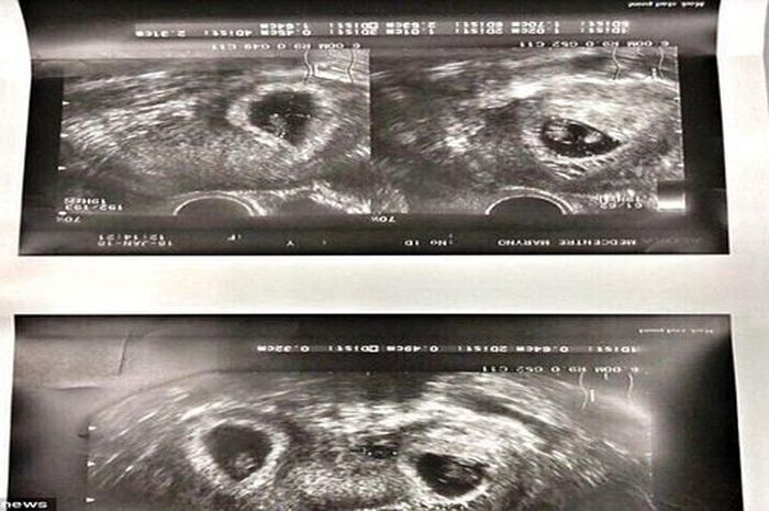 Divonis Tak Bisa Punya Anak Karena Rahim Berbentuk Hati, Perempuan Ini ...