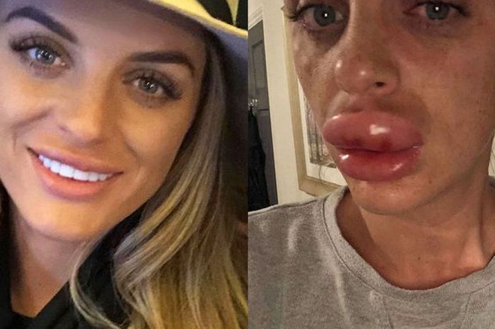 Suntik Filler di Sebuah Pesta, Bibir Perempuan Ini Bengkak 5 Kali ...