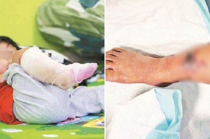 Berawal Dari Gigitan Serangga, Kaki Balita 2 Tahun ini Terancam ... Berawal Dari Gigitan Serangga, Kaki Balita 2 Tahun ini Terancam ...