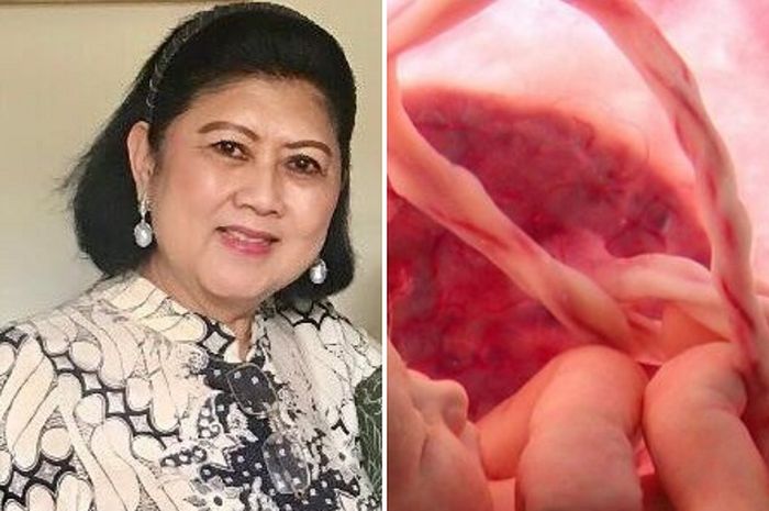 Ani Yudhoyono Idap Kanker Darah, Terkuak Tali Pusar Bisa Jadi Penyembuh ... Ani Yudhoyono Idap Kanker Darah, Terkuak Tali Pusar Bisa Jadi Penyembuh ...
