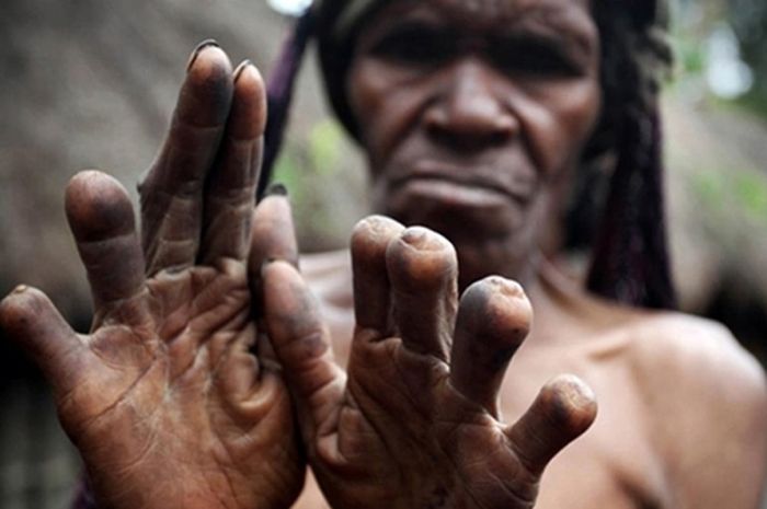 Iki Palek, Ritual Potong Jari yang Dilakukan Suku Dani Setiap Ada ...