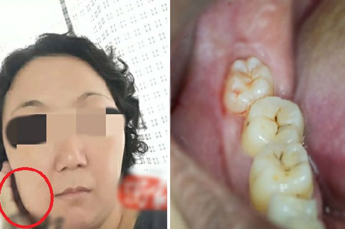 Wanita Meninggal 5 Hari Usai Cabut Gigi Bungsu Keluarganya Tak Terima