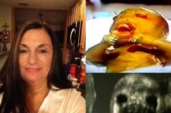 Kisah Kelahiran 'Bayi Setan' Bertahan Hidup Tanpa Air Ketuban di Dalam ...