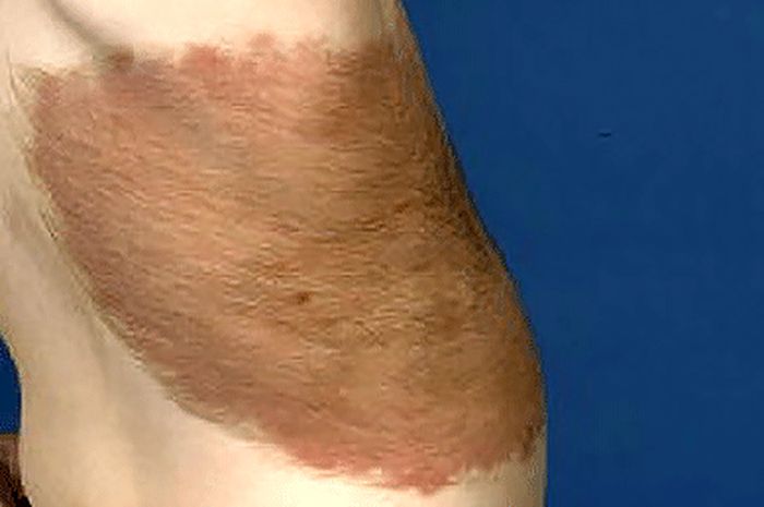 Teknik Baru Deteksi Kanker Kulit Melanoma, Ini Gejala yang Diwaspadai ...