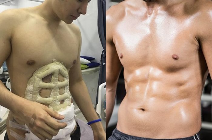 Demi Punya Perut Berotot Secara Instan, Tren Operasi Six Pack Diburu ...
