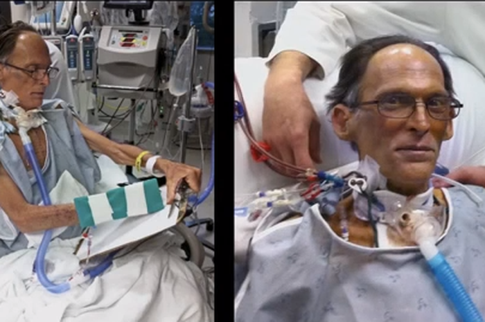 Kisah Craig Lewis, Orang Pertama di Dunia yang Hidup Tanpa Jantung ...