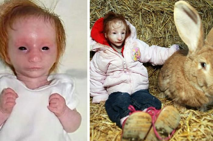 Kisah Bayi Menderita Primordial Dwarfism, Emma Panik Melahirkan Bayi ...