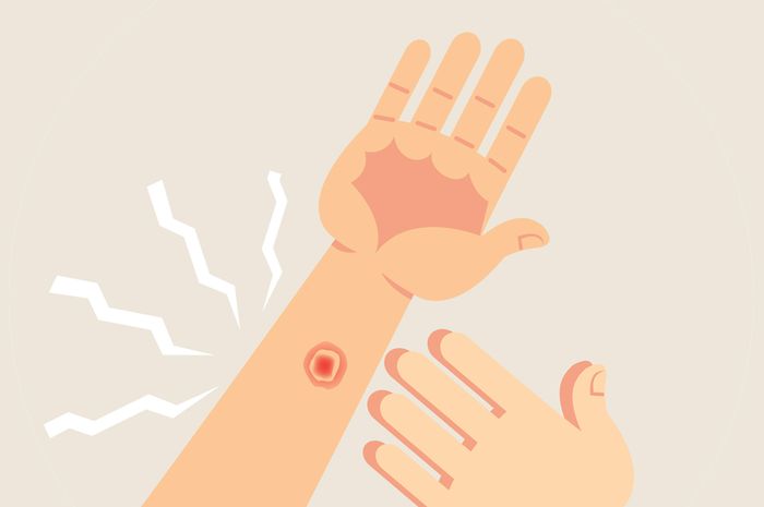 Cara Mudah Mengatasi Bisul, Cukup Gunakan 4 Bahan Alami Ini, Salah ...