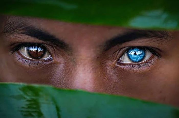 Memiliki Sindrom Waardenburg Suku Asli Di Pulau Buton Ini Memiliki