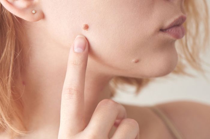Kenali Skin Tag yang Mirip Seperti Kutil, Gimana Cara Menghilangkannya ...
