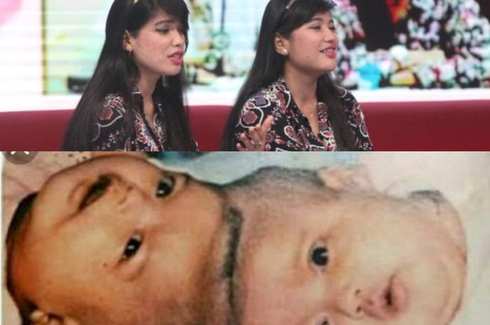 Nasib Yuliana Yuliani, Kembar Siam Dempet Kepala yang 34 Tahun Lalu Berhasil Dioperasi, Kini ...