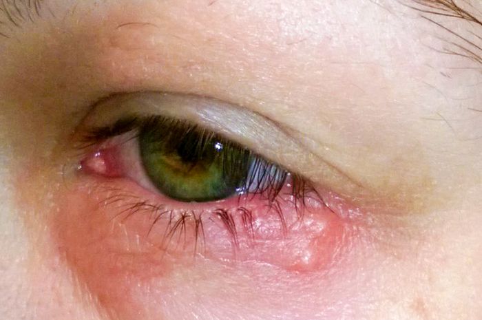 Penyakit Infeksi Jamur pada Mata, Penyebab dan Cara Mengobatinya - Grid ...