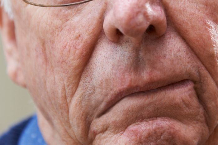 Terlihat Mirip, Ini Beda Bell's Palsy dengan Penyakit Stroke - Grid Health