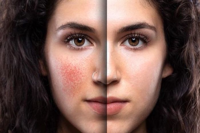 Jitu! Ini 8 Cara Mengatasi Kemerahan di Wajah Menurut Dermatologis ...
