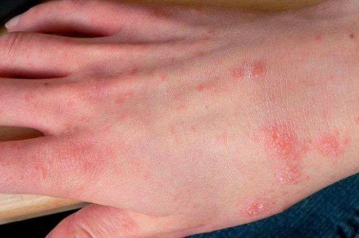 Kenali Jenis Penyakit Infeksi Kulit Berdasarkan 3 Penyebabnya - Grid Health