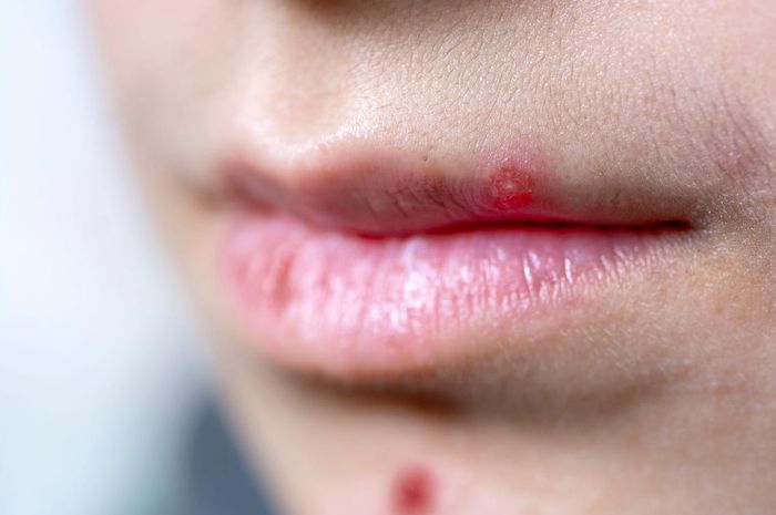 Inilah Penyebab Jerawat di Bibir dan Cara Mengatasinya dengan Mudah - Stylo