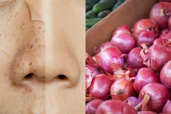 Ngapain Buang Duit Buat Perawatan, Flek Hitam di Wajah Bisa Minggat ...