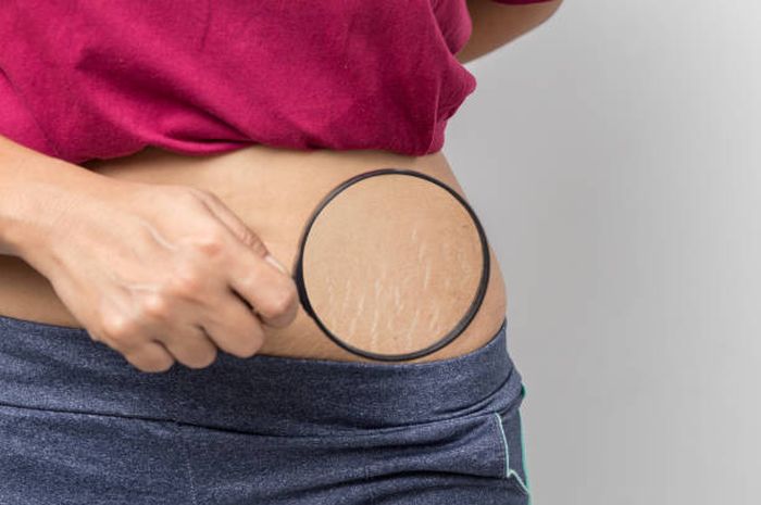 5 Cara Menghilangkan Stretch Mark Tanpa Bahan Kimia Secara Cepat dan ...