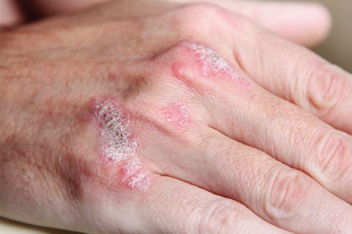 4 Bukti Mengejutkan Hidup Dengan Eksim Dapat Mempengaruhi Kesehatan ...