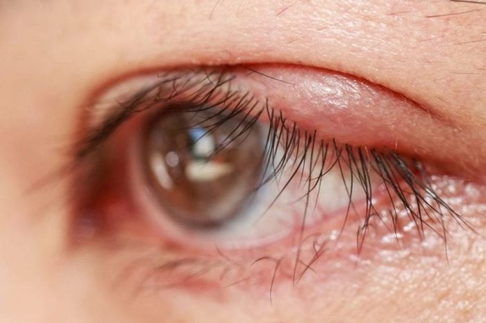 7 Main Symptoms Of Blepharitis Inflammation That Makes Eyelids Swollen
