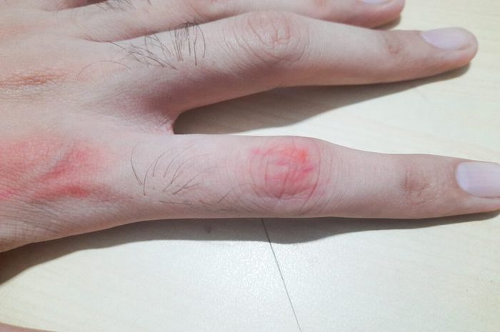 Jangan Panik Dulu! Redakan Ruam di Tubuh dengan 4 Cara Ini, Salah ...